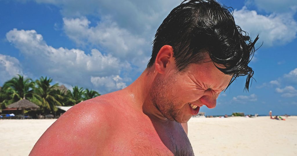 5 Tips for Treating Sunburn - Oceanic Worldwide